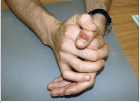 Պիոգեն գրանուլոմա — «Պրոֆ Հ Ա Քալամքարյանի անվան Մաշկավեներաբանության և մաշկի օպտիկական