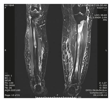 Mri Of Left Tibia With Without Iv Contrast Download Scientific Diagram