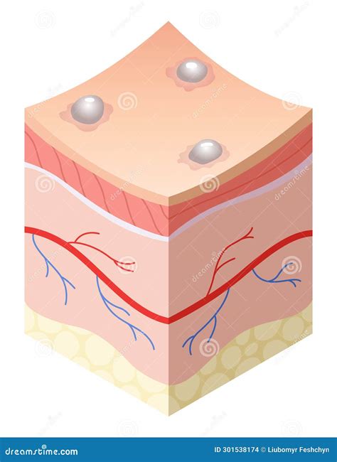Skincare Medical Concept Problems In Cross Section Of Human Skin Horizontal Layers Structure