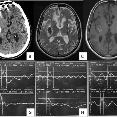 Image After Second Stroke A Axial Non Contrast Ct Scan Shows Acute Download Scientific Diagram