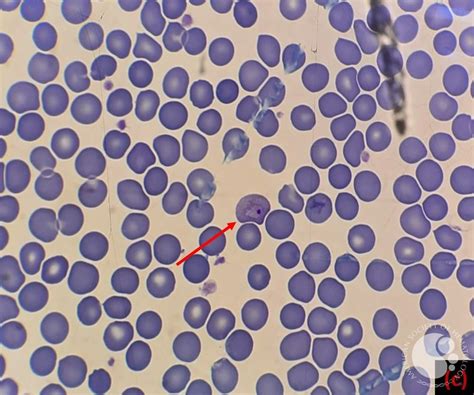 Plasmodium Vivax Ring Form With S Single Chromatin Dot