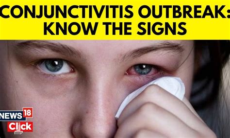Conjunctivitis Outbreak News Know The Detailed Signs Symptoms