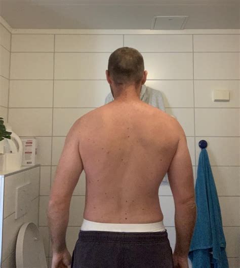 Is Sex More Difficult With Titanium Rods In Your Spine Rscoliosis