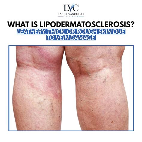 Lipodermatosclerosis Refers To Laser Vascular Center
