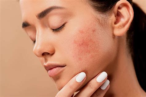The Hormonal Acne Diet The Best Foods For Healthy Clear Skin Abbey
