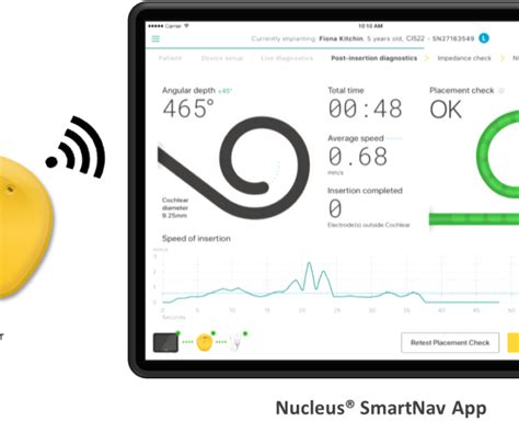 Smartnav Archives Cochlear Pronews