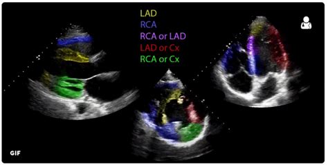 Focus On Pocus Heartbreaker Cardiac Echo In The Ed Emottawa Blog
