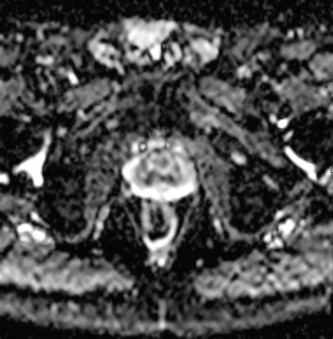 Screening For Prostate Cancer Using Biparametric Bp Mri Prostate