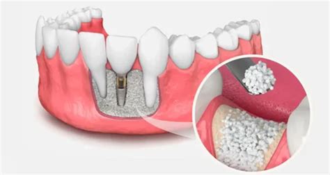 Bone Graft In Mouth Complete Guide To Procedure And Recovery