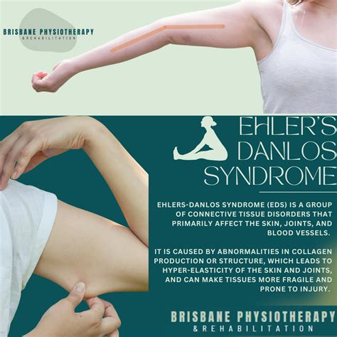 What Is Eds Ehlers Danlos Syndrome