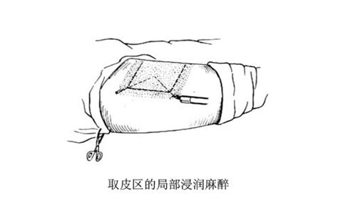 管状皮瓣皮管移植术 手术图解 医学图库