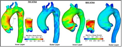 Computational Fsi Analysis For Inner And Outer Maximum Wps In Ataa Download Scientific Diagram