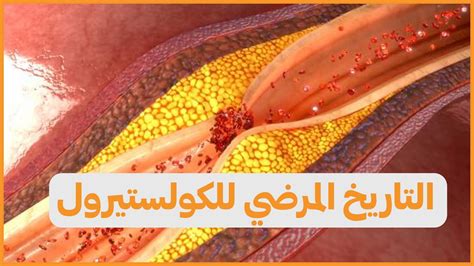 Cholesterol التاريخ المرضي للـ كولستيرول Youtube