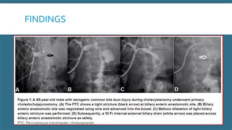 Ptc Percutaneous Transhepatic Cholangiography Pptx