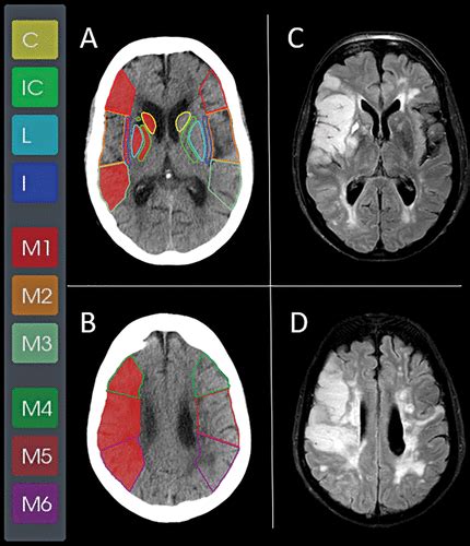 Automated Calculation Of The Alberta Stroke Program Early Ct Score