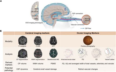 Retinal Vascular Morphology Reflects And Predicts Cerebral Small Vessel Disease Evidences From
