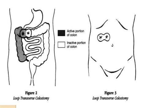 Colostomy Care PPTX