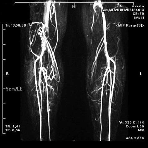 Arterial Occlusion And Developed Collaterals Download Scientific Diagram