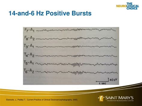 Ppt Benign Eeg Variants And Patterns Of Unknown Significance Powerpoint Presentation Id2287312