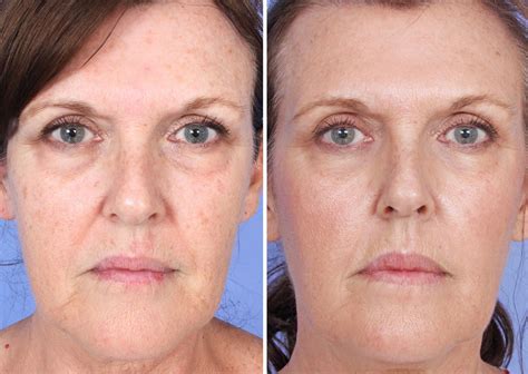 Microneedling With Prp Before And After Results Photos
