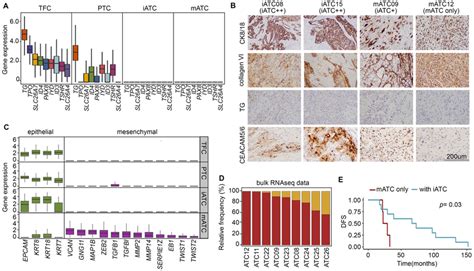 Characteristics Of Epithelial Cell Subtypes In Thyroid Cancer A Box