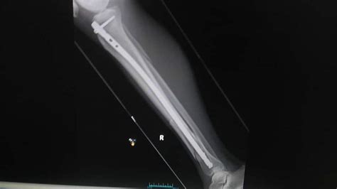 Compound Fracture Of Tibia And Fibula Recovery