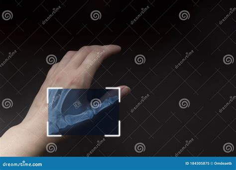 Microchip Under The Skin In An X Ray People Chipping Concept Spying On People Future Chipping