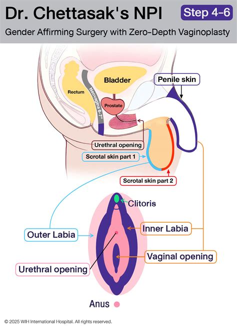 Zero Depth Vaginoplasty Bangkok Wih And Dr Chettasak Npi