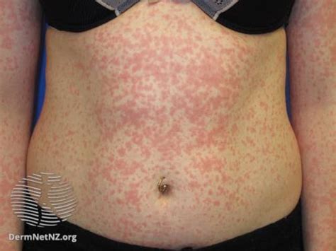 Signs And Causes Of A Maculopapular Rash