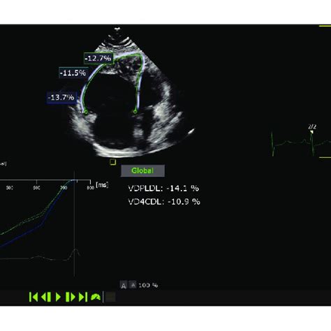 Autostrain Rv Tomtec Apical Form Of Hypertrophic Cardiomyopathy Download Scientific Diagram