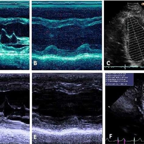 Echocardiography Was Showed That Increased Dimension And Volume Of Lv