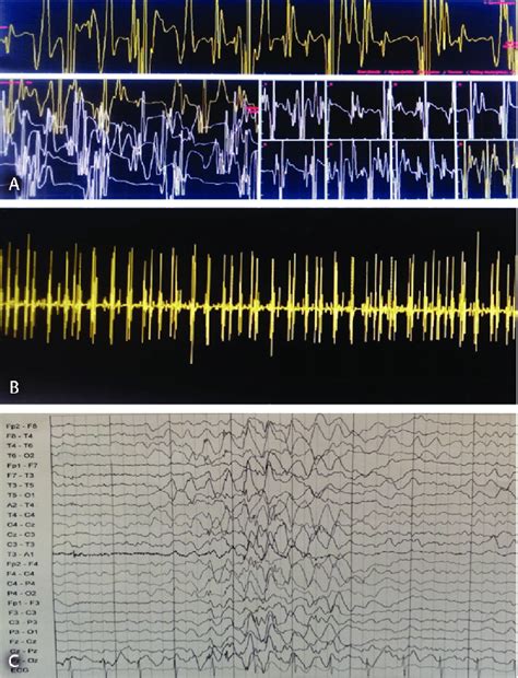 Electromyogram Showing Motor Unit Action Potentials Of Large Amplitude