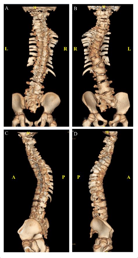 Three Dimensional Computed Tomography Ct Scan A Anterior B Download Scientific