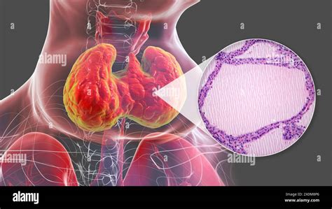 3d Illustration Of A Person With An Endemic Goitre Enlarged Thyroid