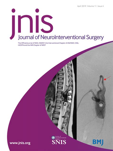 Treatment Of Intracranial Aneurysms Using The Pipeline Flex
