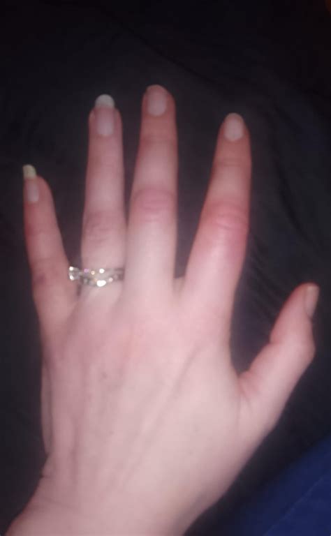 Could This Be Chilblains R Raynauds