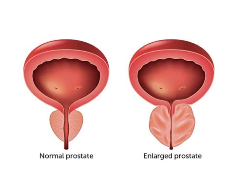 Acquablation Therapy A Minimally Invasive And Effective Treatment For Benign Prostatic
