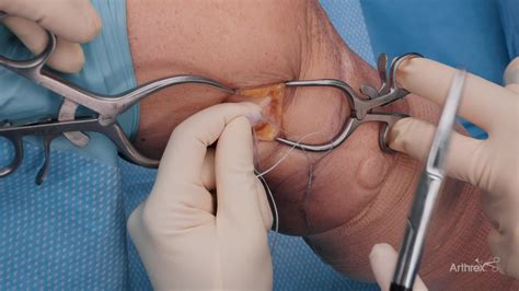 Arthrex Lateral Extra Articular Tenodesis Let Using The Knee