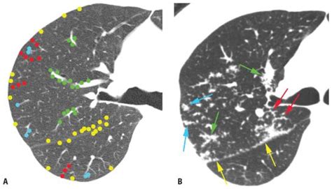 Nodular Lung Disease Radiology Key