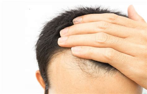 5 Early Signs Of Balding And What You Can Do About It 5 Early Signs Of Balding And What You Can Do About It