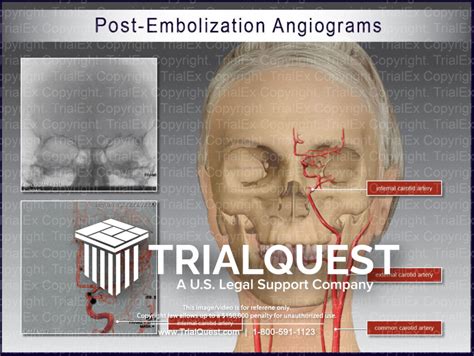Post Embolization Angiograms Trialquest Inc
