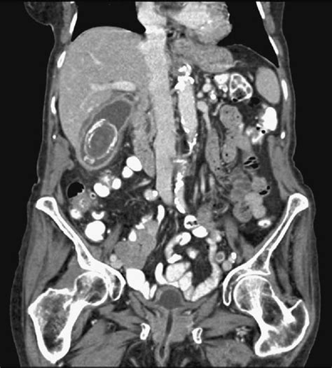 Ct Scan 5 Months Prior To Colonic Perforation Showing The Large Download Scientific Diagram