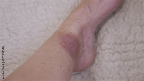 Close Up Formation Of A Large Red Spot On The Skin From A Tick Bite