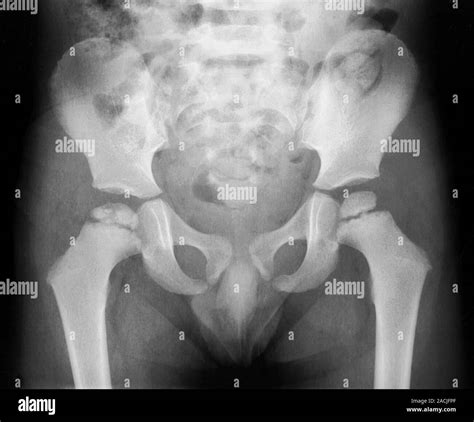 X Ray Front View Of The Pelvis In An 8 Year Old Patient Showing