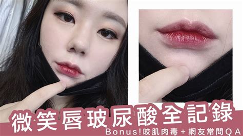 零死角美唇微笑唇玻尿酸 咬肌肉毒全記錄 網友常見問題一次解答AiNa 愛娜 YouTube