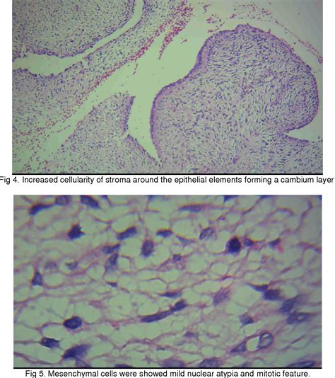 [pdf] Adenosarcoma Of The Uterus A Case Report Semantic Scholar