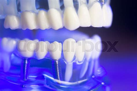 Dental Alignment Teeth Model Stock Image Colourbox