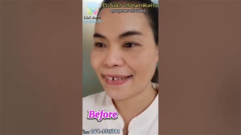 ยิ้มสวยฉับพลัน ไม่แพงเหมือนจัดฟันด้วยนะ โปรโมชั่น 8 ซี่ 19 999 บาท จากปกติ 40 000 บาท Youtube