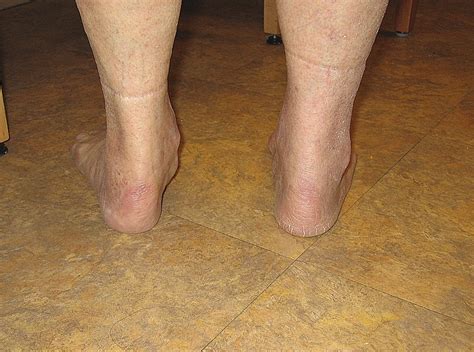 The Flexible Flatfoot In The Adult Foot And Ankle Clinics