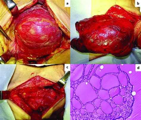 Intraoperative Findings And Postoperative Pathology A The Goiter Was